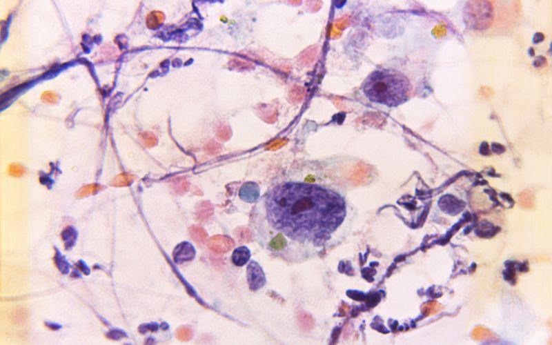 Filamentos de mucina: qué son, causas, enfermedades asociadas