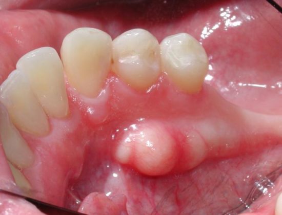 Torus mandibular: concepto, síntomas, causas, tipos, tratamiento
