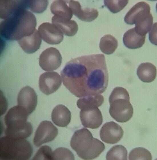 Eosinófilos: características, morfología, funciones, enfermedades