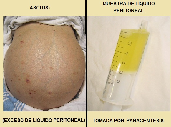 Líquido peritoneal: composición, funciones, cultivo y análisis