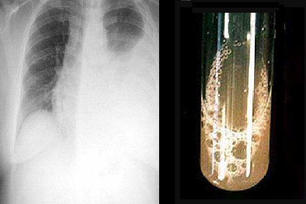 Líquido pleural: funciones, dónde se produce, cultivo, análisis