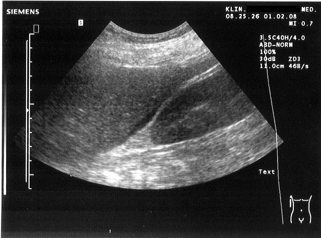 Espacio de Morison: qué es, anatomía, función, enfermedades