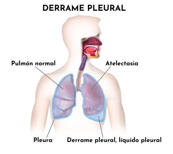 Líquido pleural: qué es, funciones, dónde se produce, cultivo, análisis
