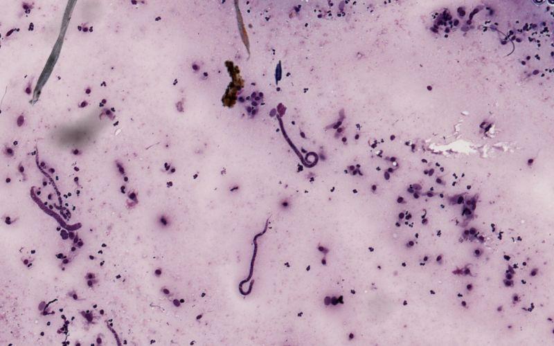 Onchocerca volvulus: qué es, características, ciclo biológico, tratamiento