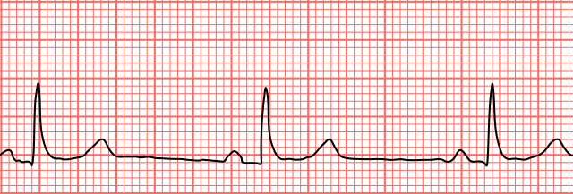 Dromotropismo: qué es, electrofisiología cardiaca, patologías