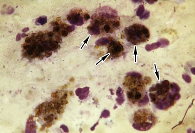 Hemosiderina: características, enfermedades y diagnóstico