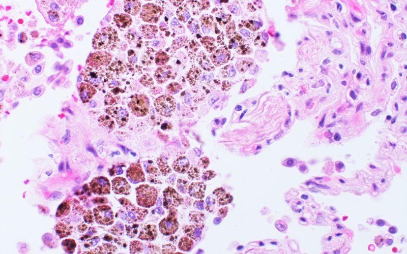 Hemosiderina: qué es, características, enfermedades