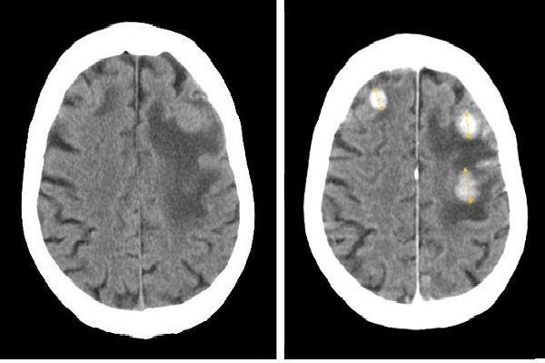 Edema Cerebral Síntomas Causas Y Tratamiento