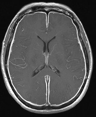 Edema cerebral: qué es, causas, tipos, síntomas, tratamientos