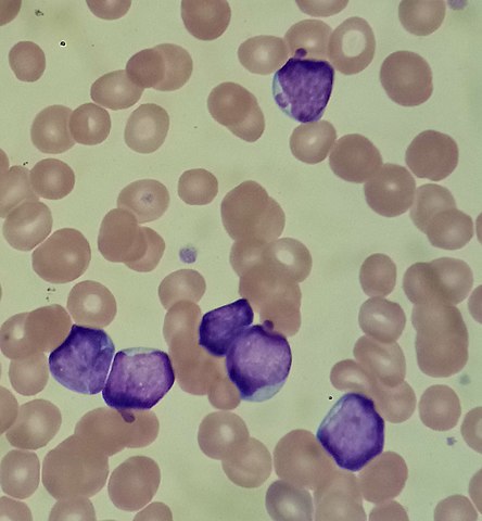 ¿Qué son los linfoblastos?